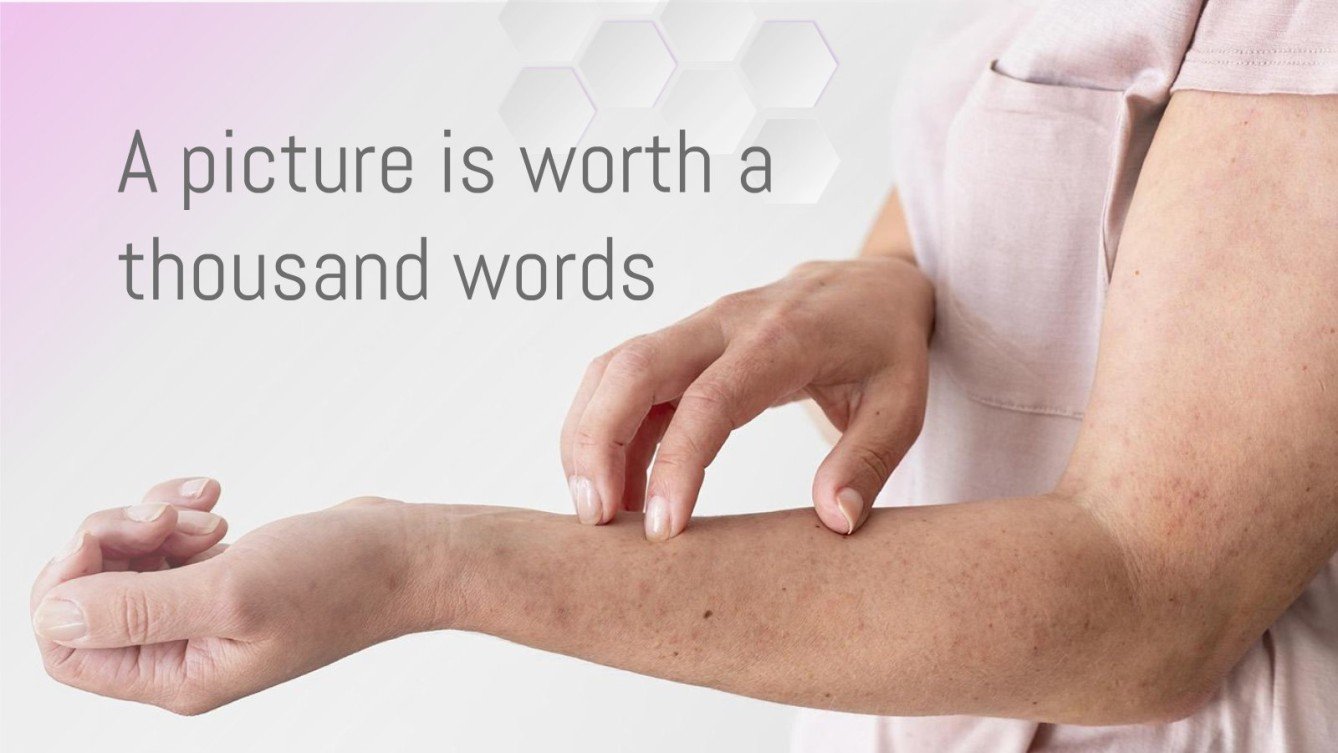 World Atopic Eczema Day | Google Slides & PowerPoint