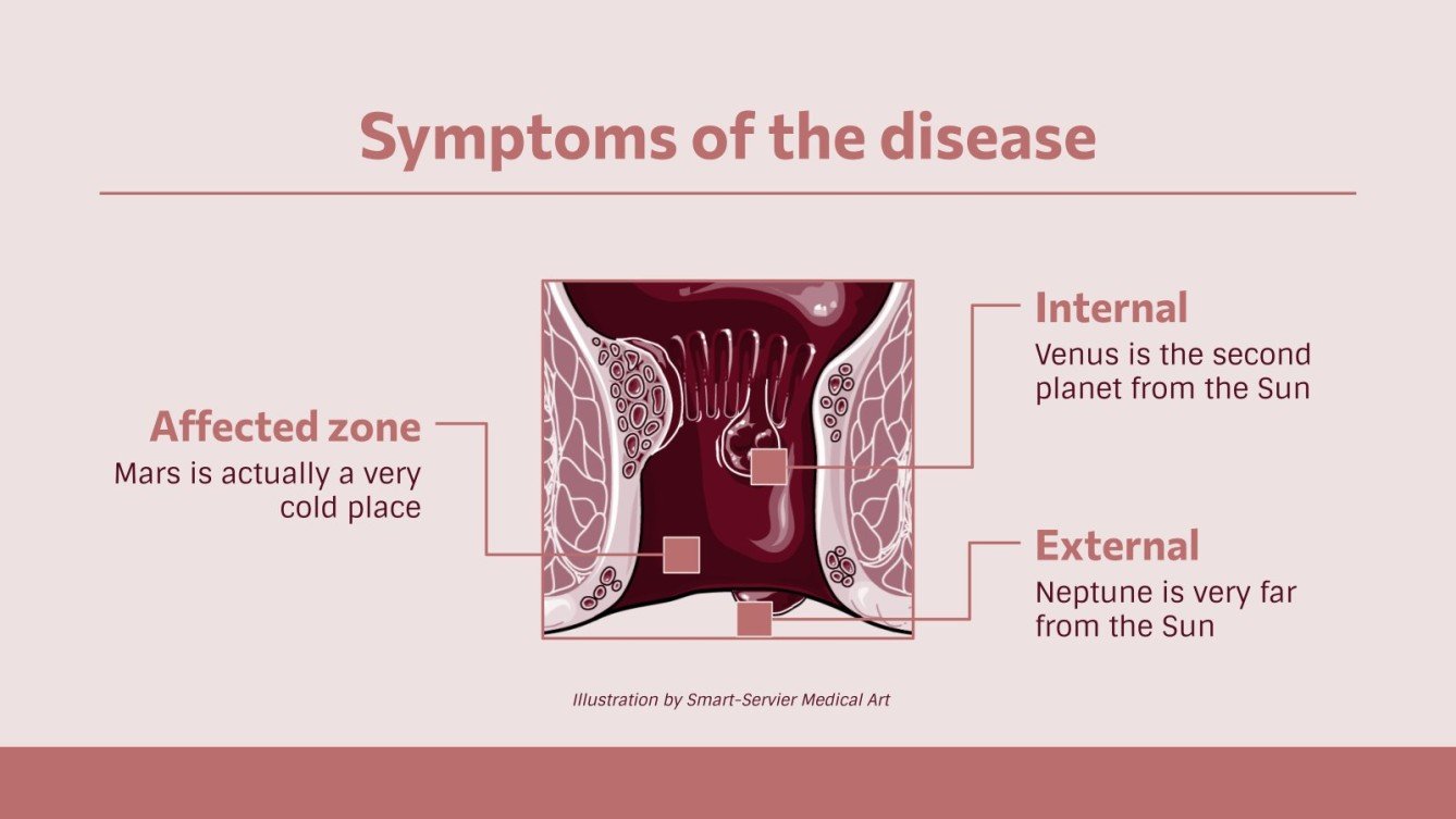 Digestive Problems: Hemorrhoids | Google Slides & PowerPoint