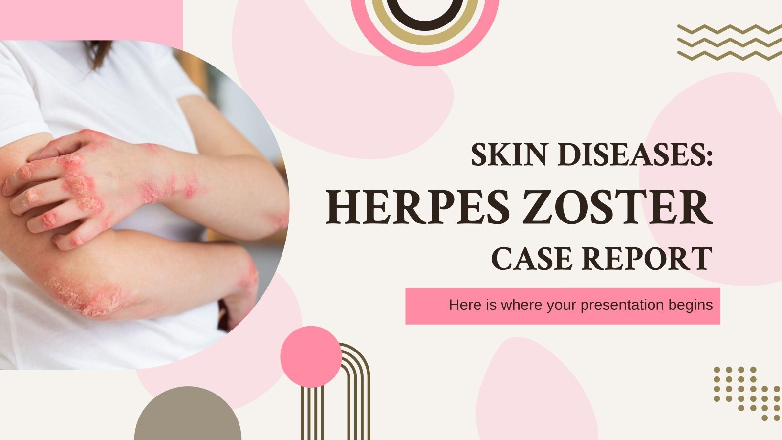 Enfermedades de la piel: Informe de un caso de herpes zóster