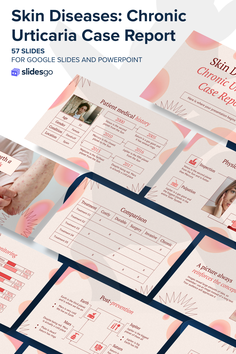 Skin Diseases: Chronic Urticaria Case Report | Google Slides