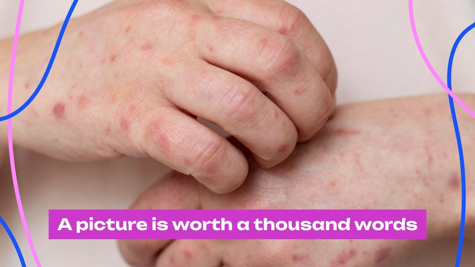 Caso clínico de lepra infantil | Google Slides y PowerPoint