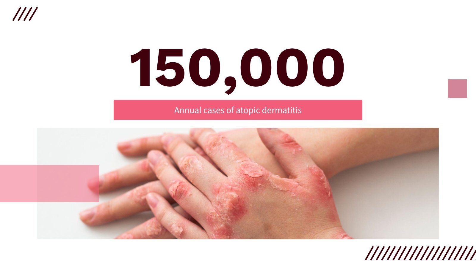 Dermatite atópica: eczema | Google Slides e PowerPoint