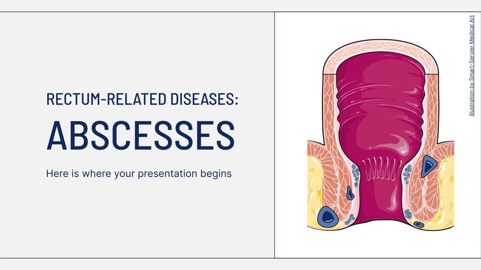 Rectum-Related Diseases: Abscesses | Google Slides & PPT