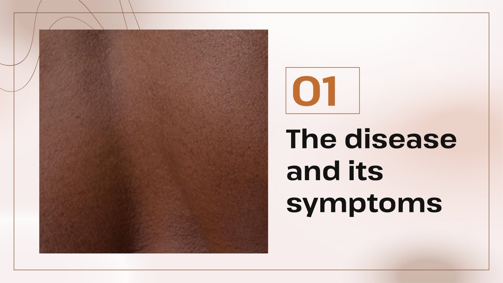 Erythematous Systemic Lupus Presentation