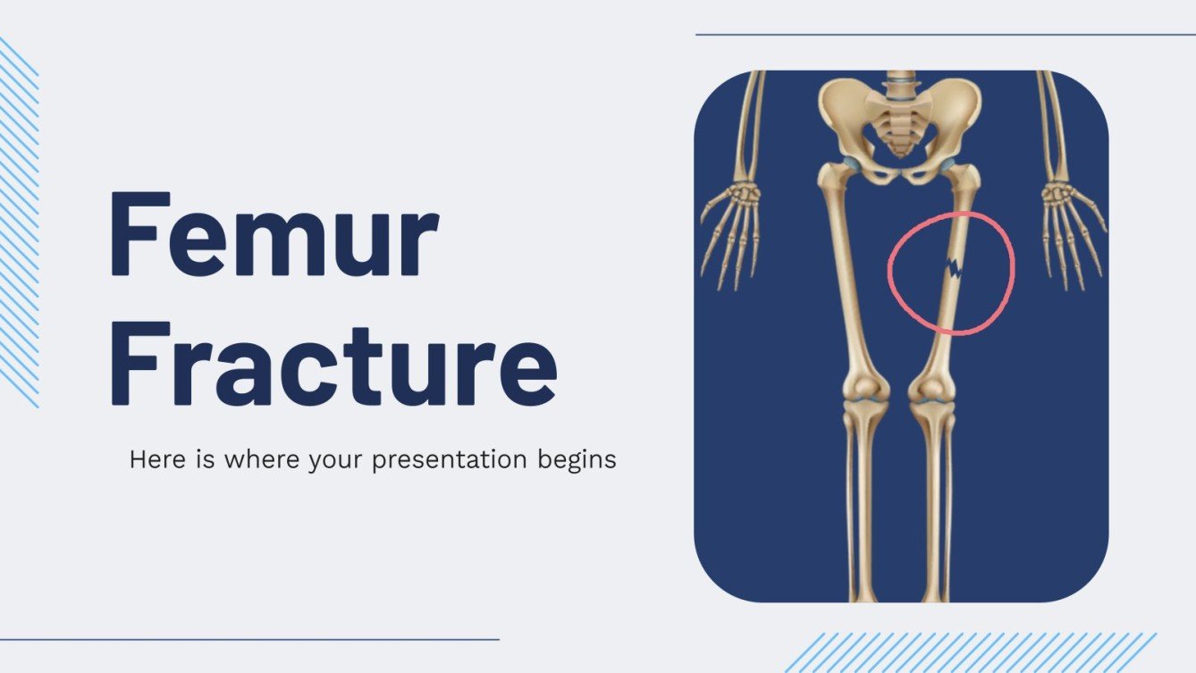 Femur Fracture Presentation