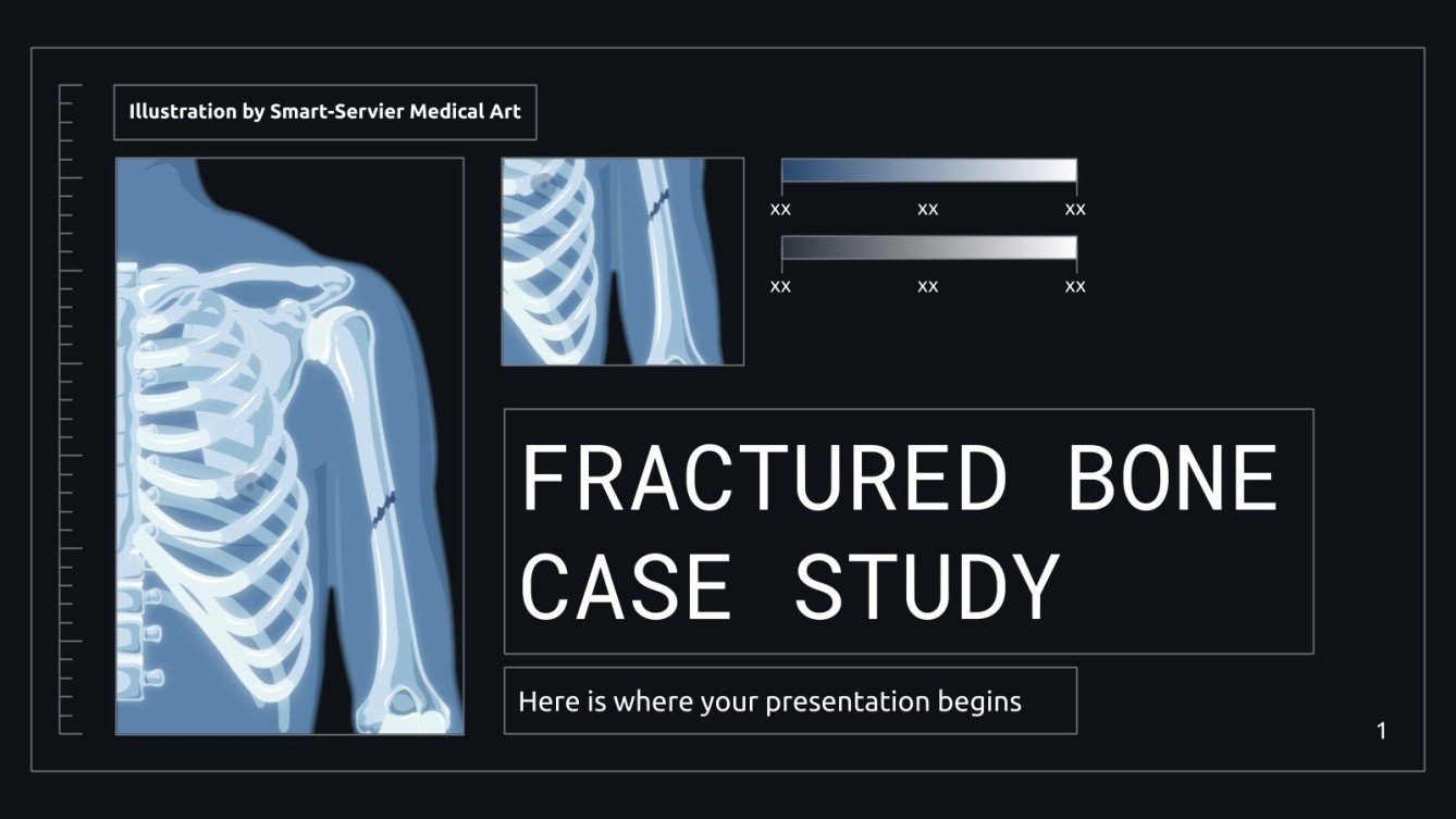 Fractured Bone Case Study Presentation