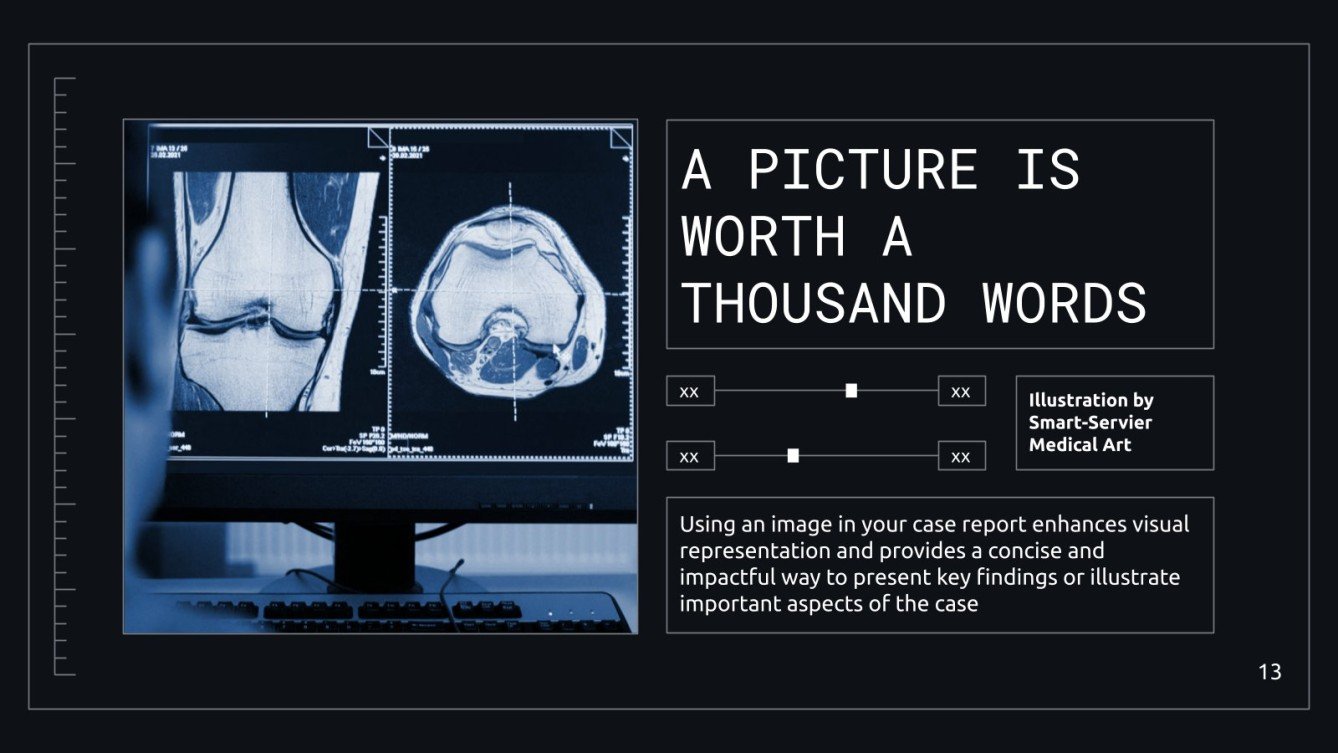Fractured Bone Case Study Presentation
