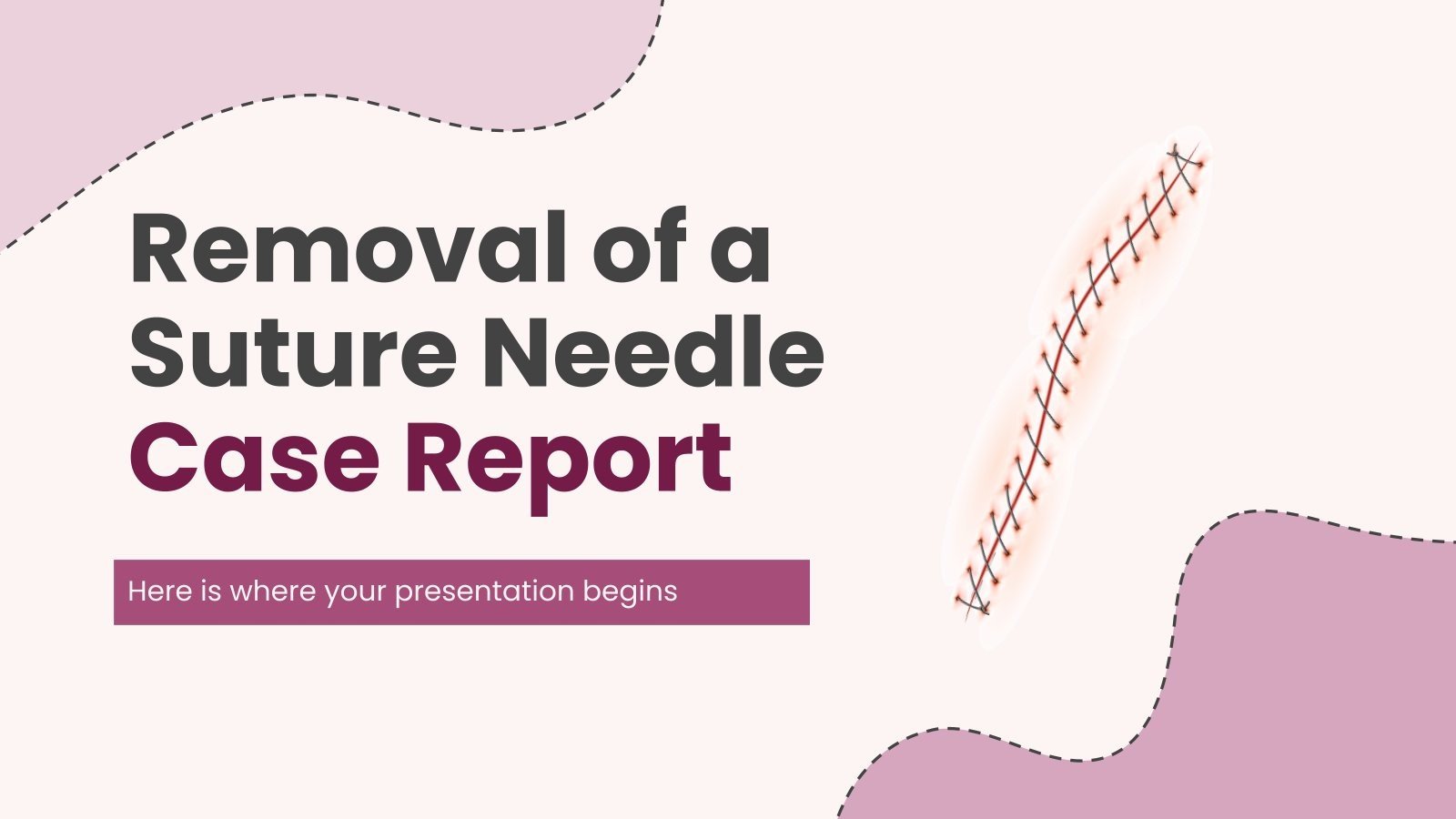 Removal of a Suture Needle Case Report Presentation