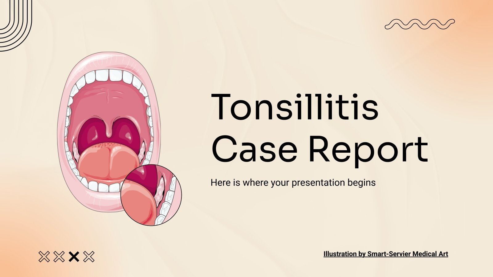 Tonsillitis Case Report Presentation